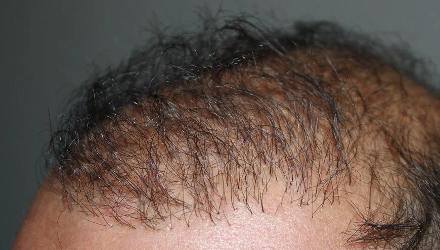 Bad Hair Transplant:11 Reasons of it and How it Can be Fixed